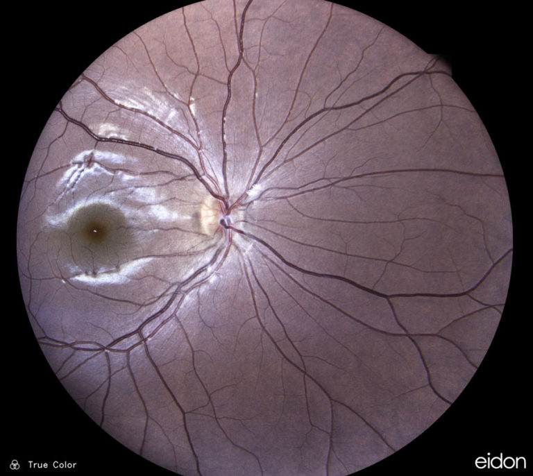 Optomap Retinal Imaging | Eye Exams Services Hamilton